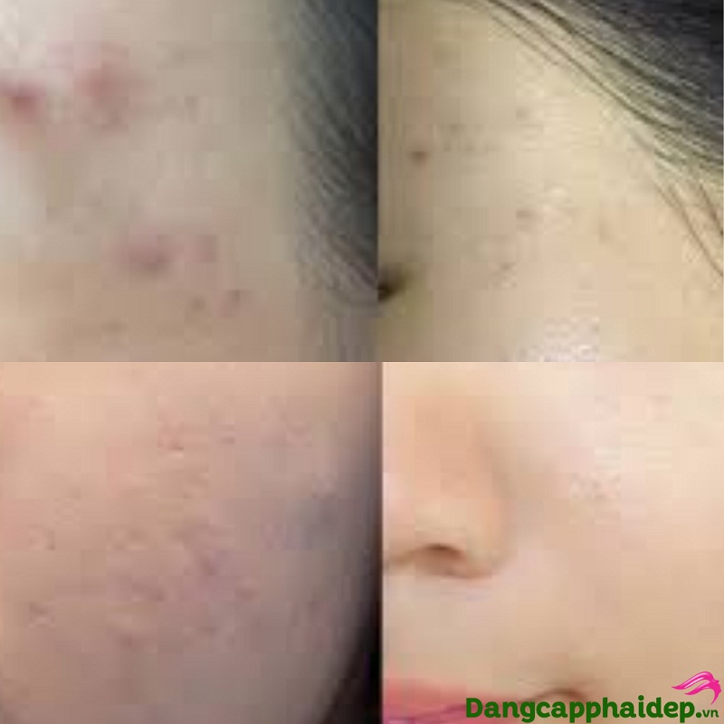 Jean D’Arcel Blemish Control kem trị mụn tận gốc sáng da