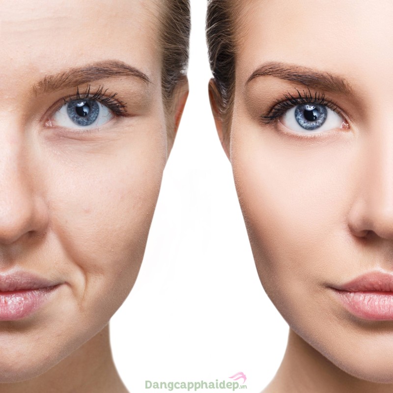 Mesoestetic C.prof 213 Mesotox Solution giảm nhăn, chống lão hóa